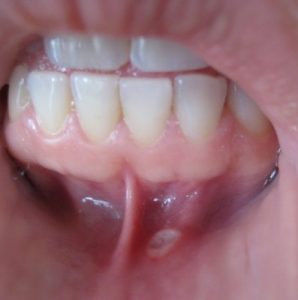 Canker Sores | Sonoran Hills Dental